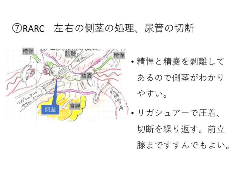 ロボット支援腹腔鏡下膀胱全摘除（RARC)+回腸導管造設術 – 泌尿器科医 澤田のブログ